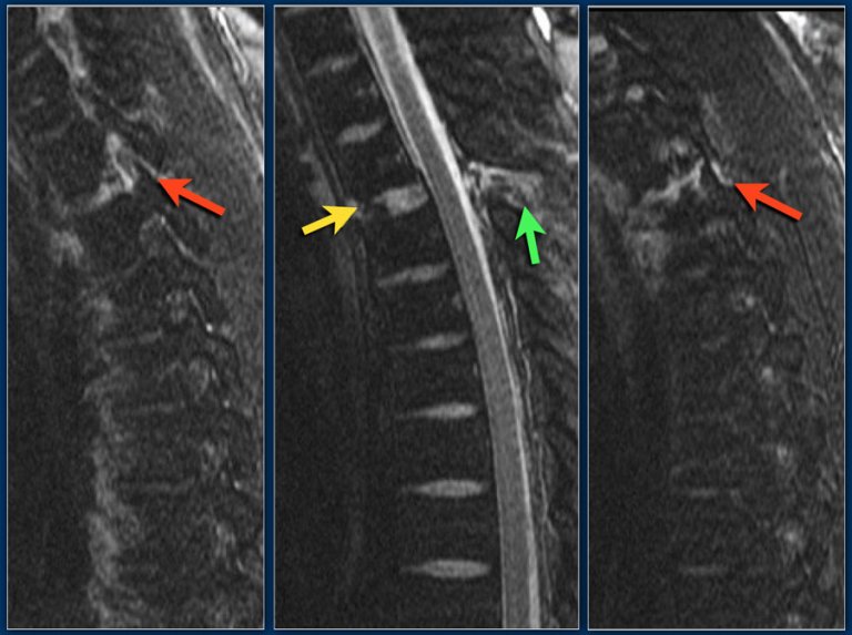 The Radiology Assistant : Spine fractures - TLICS Classification