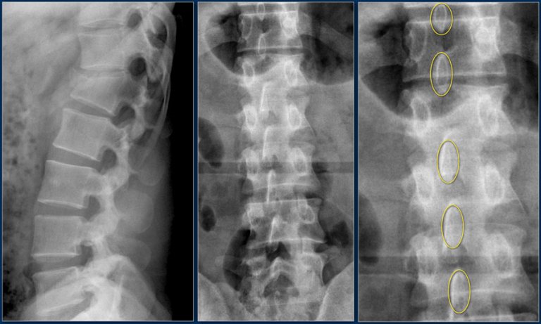 The Radiology Assistant : Spine fractures - TLICS Classification