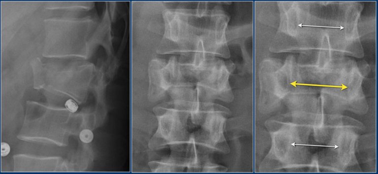 The Radiology Assistant : Spine fractures - TLICS Classification