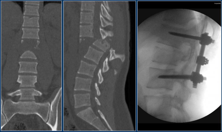 The Radiology Assistant : Spine fractures - TLICS Classification