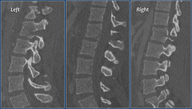 The Radiology Assistant : Spine fractures - TLICS Classification
