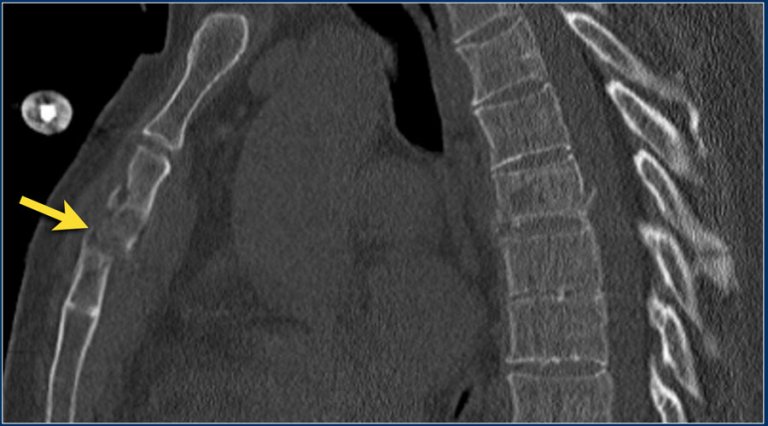 The Radiology Assistant : TLICS Classification of fractures