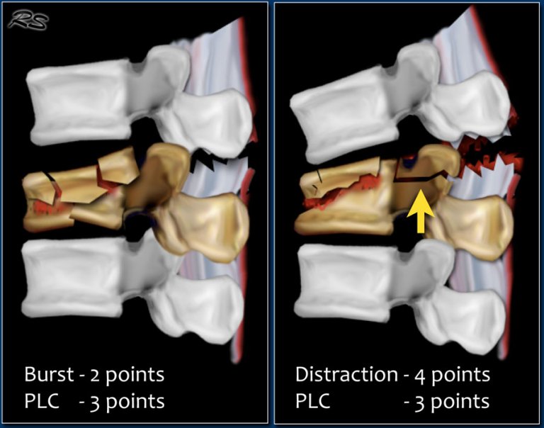 The Radiology Assistant : TLICS Classification of fractures