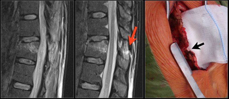 The Radiology Assistant : TLICS Classification of fractures