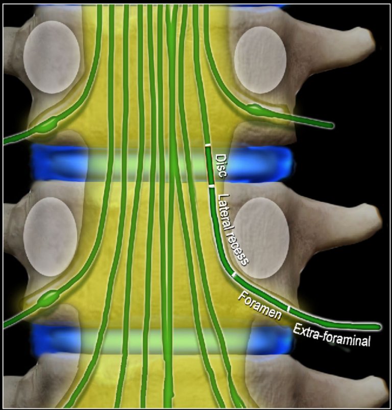 The Radiology Assistant : Lumbar Disc Herniation