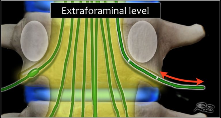 The Radiology Assistant : Lumbar Disc Herniation