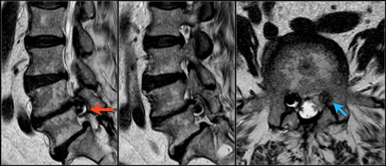 The Radiology Assistant : Lumbar Disc Herniation