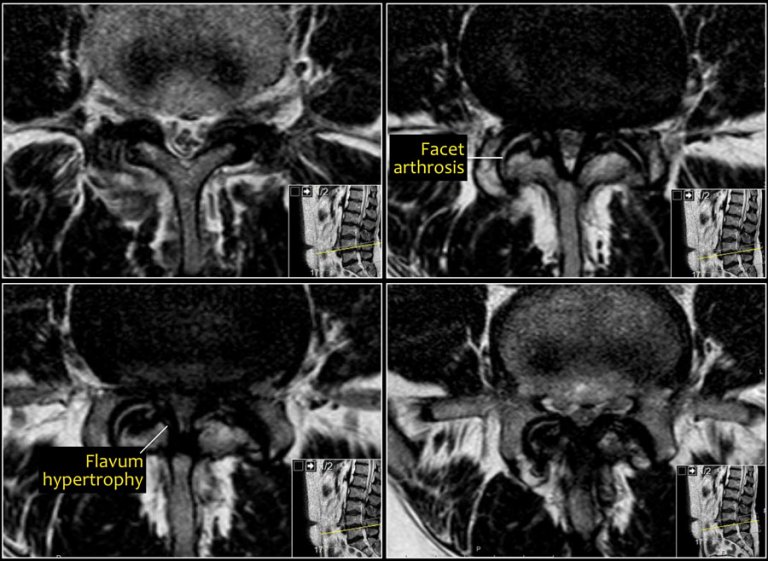 The Radiology Assistant : Lumbar Disc Herniation