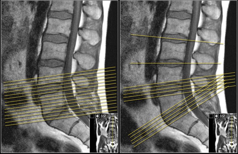 The Radiology Assistant : Lumbar Disc Herniation