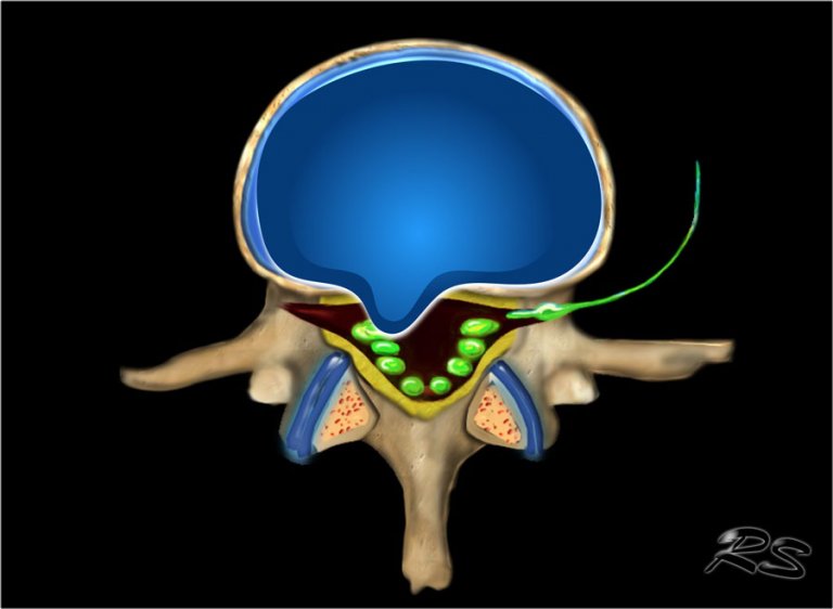The Radiology Assistant : Lumbar Disc Nomenclature 2.0
