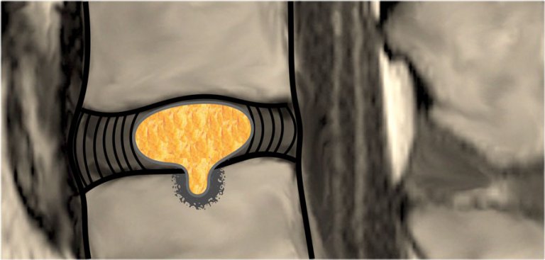 The Radiology Assistant : Lumbar Disc Nomenclature 2.0
