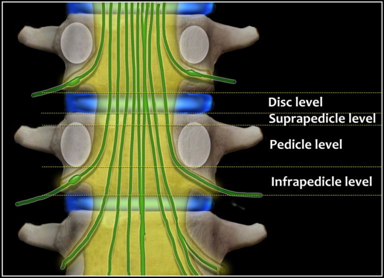 The Radiology Assistant : Lumbar Disc Nomenclature 2.0