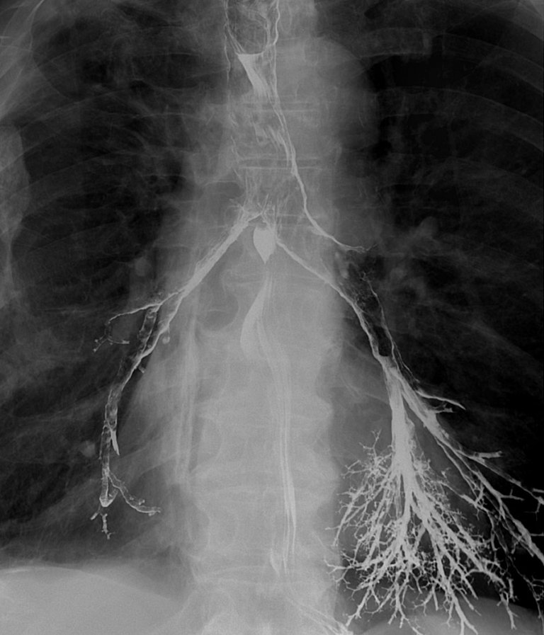 The Radiology Assistant : Swallowing disorders update