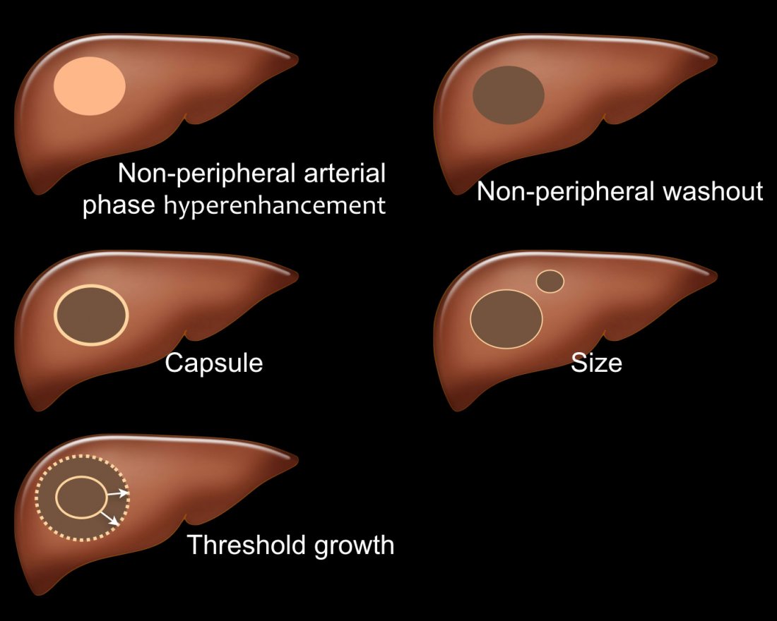 The Radiology Assistant : LI-RADS