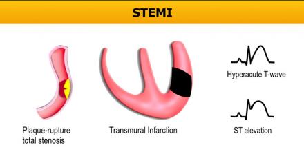 The Radiology Assistant : CAD-RADS