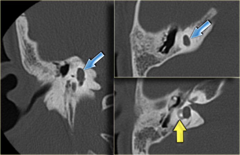 The Radiology Assistant : Temporal Bone Pathology