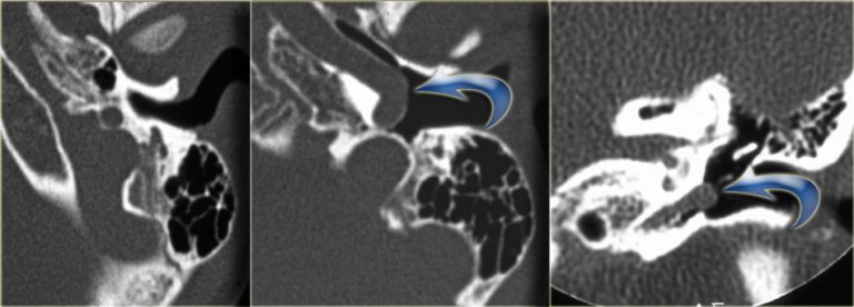 The Radiology Assistant : Temporal Bone Pathology