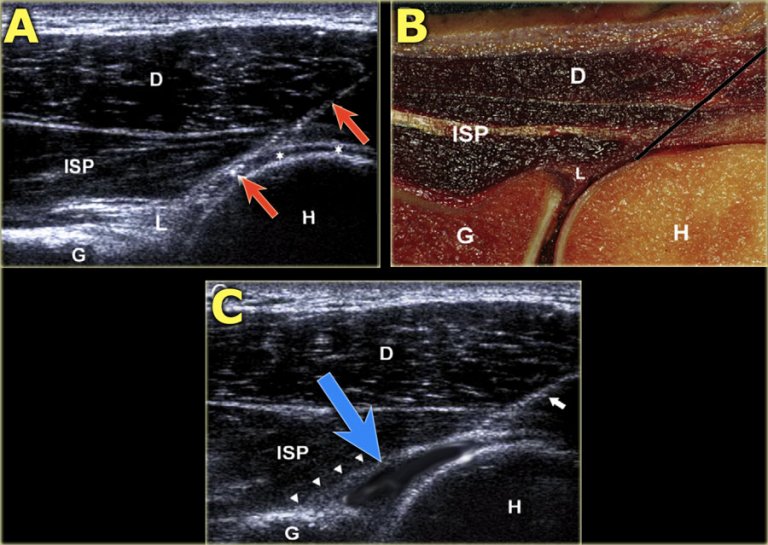 The Radiology Assistant : US-guided injection of joints