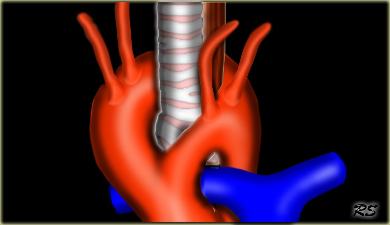 Unfolded Aorta Meaning