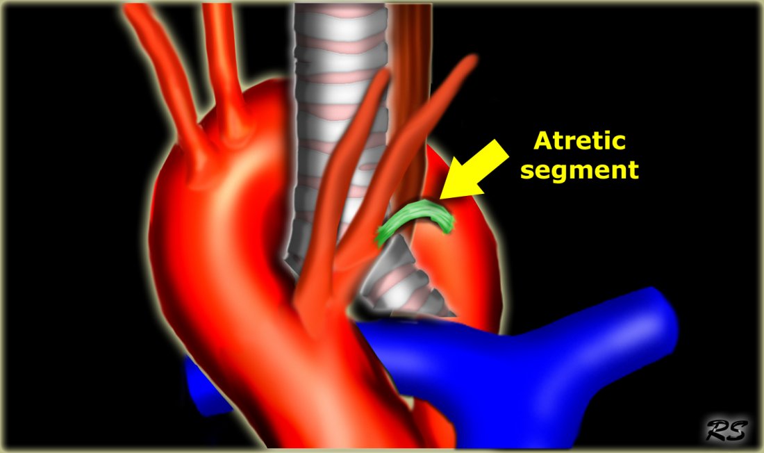 The Radiology Assistant : Vascular Anomalies of Aorta, Pulmonary and ...